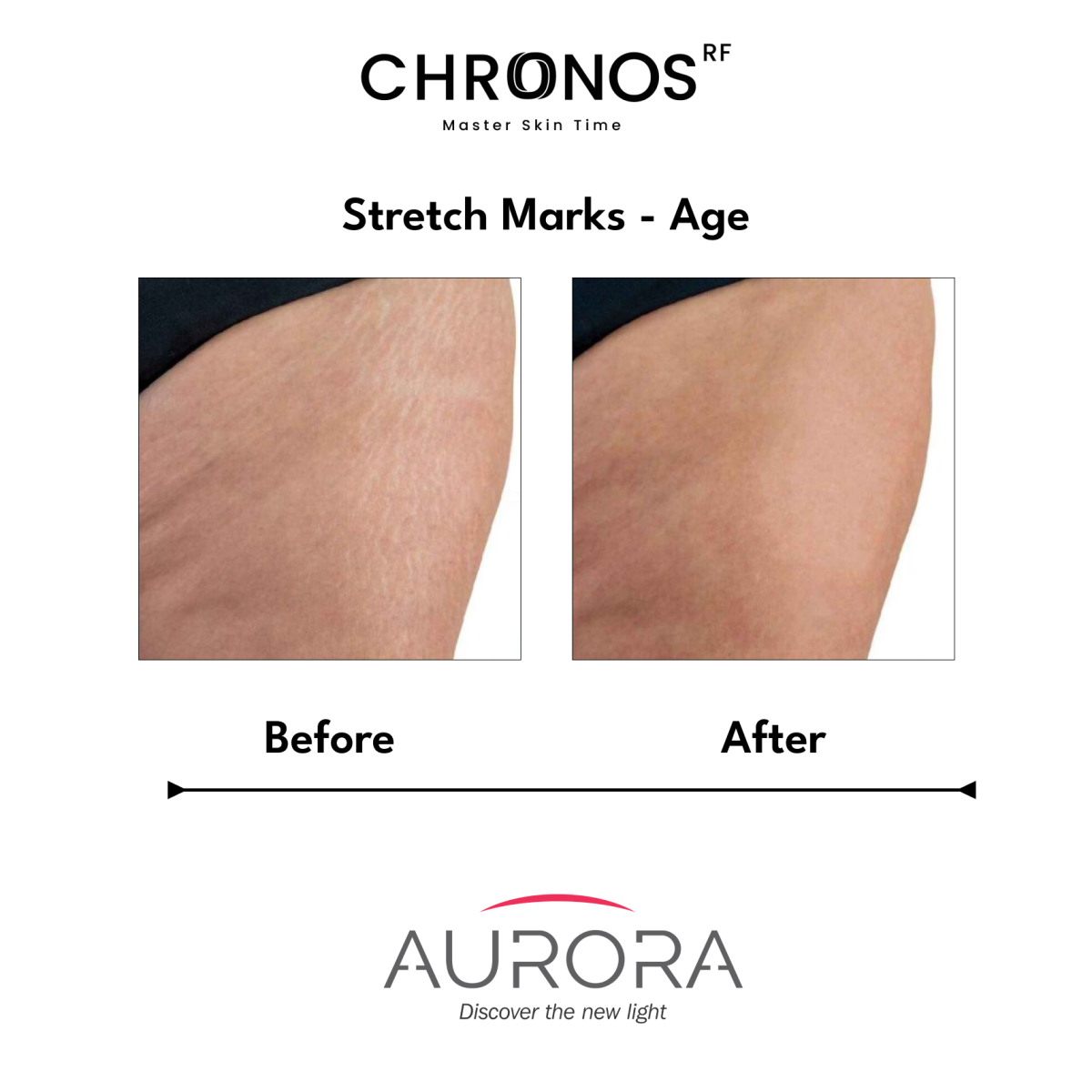 Chronos RF - Auroradermo