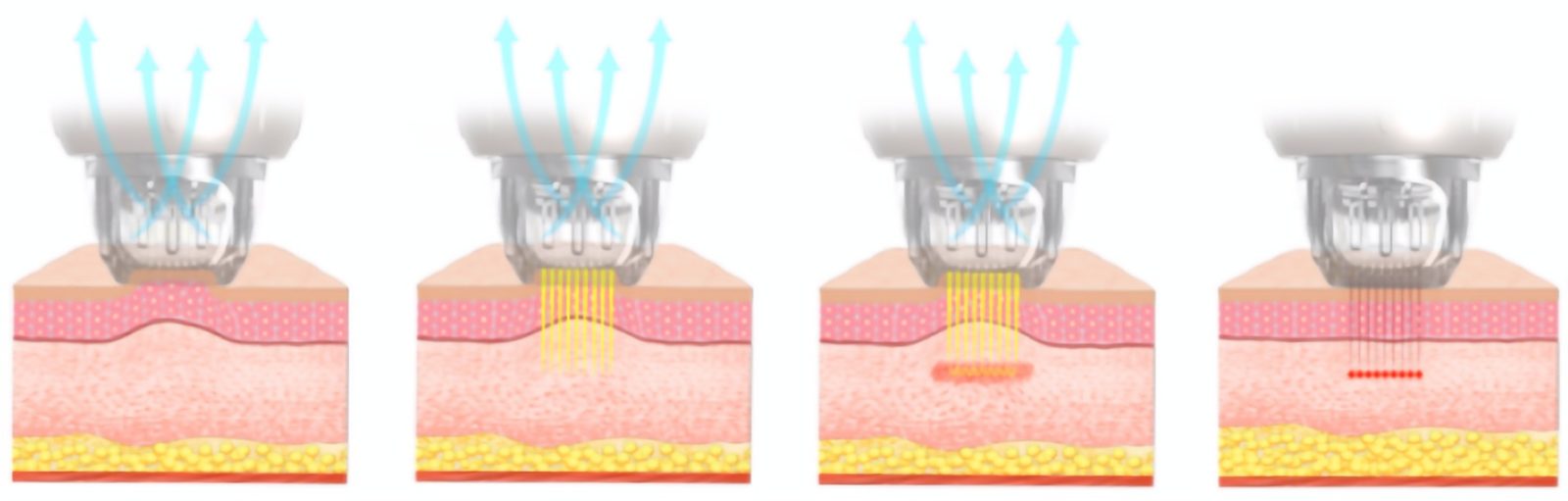 Chronos RF - Energy-based medical technology - Auroradermo