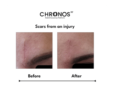 Chronos RF - Energy-based medical technology - Auroradermo